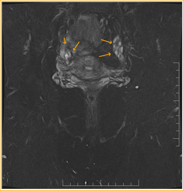 Acute PID-MRI - Sumer's Radiology Blog