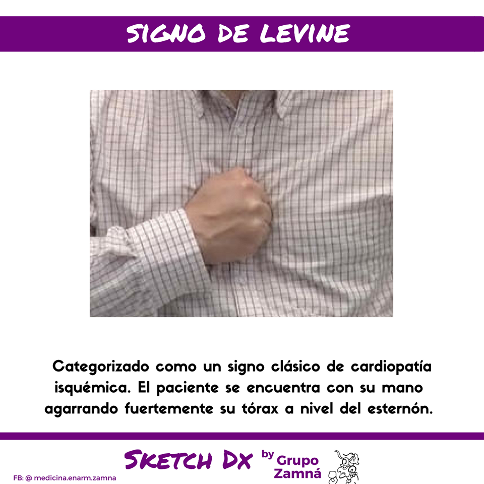 signo de levine