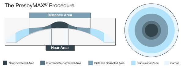 LASIK/LASEK in Seoul, Korea: June 2015
