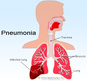 Pneumonia | Seputar Kita