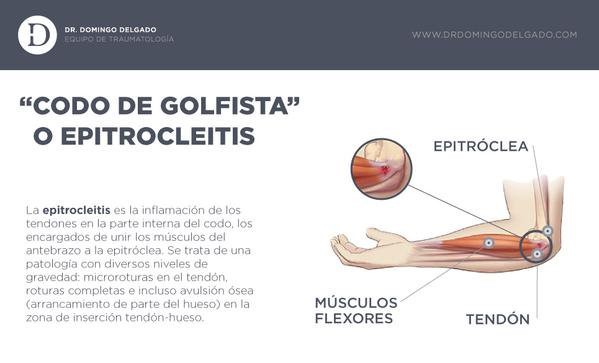 El baúl de la Fisioterapia : EPITROCLEITIS