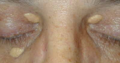 916SKIN - ACNE SKIN & WELLNESS CLINIC: Xanthoma or Acne?