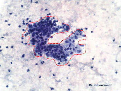 THE PERUVIAN CYTOPATHOLOGY CORNER: GANGLIO LINFÁTICO: CENTROS GERMINALES