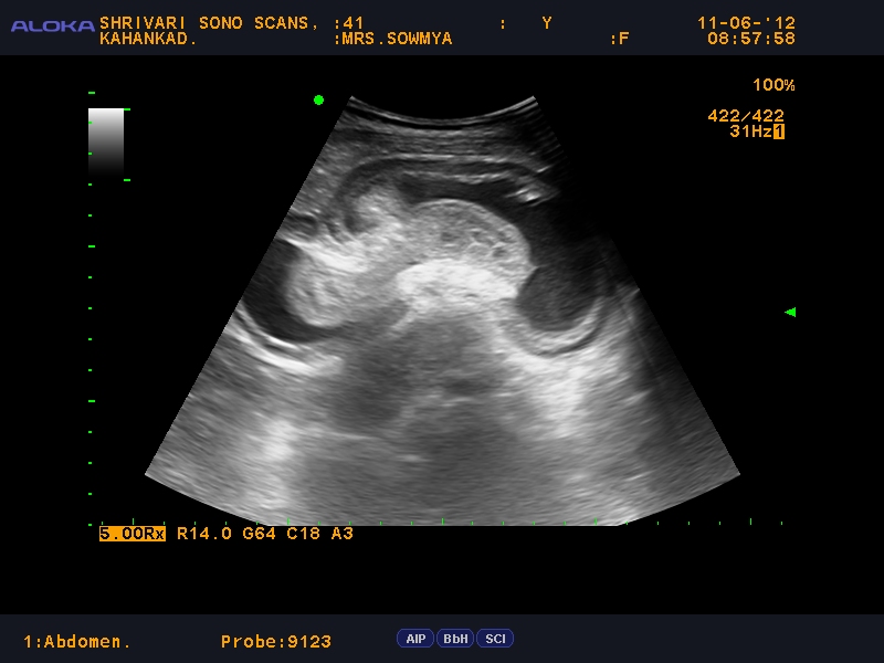 Shrivari Sono Scans: Small bowel intussusception secondary to ...