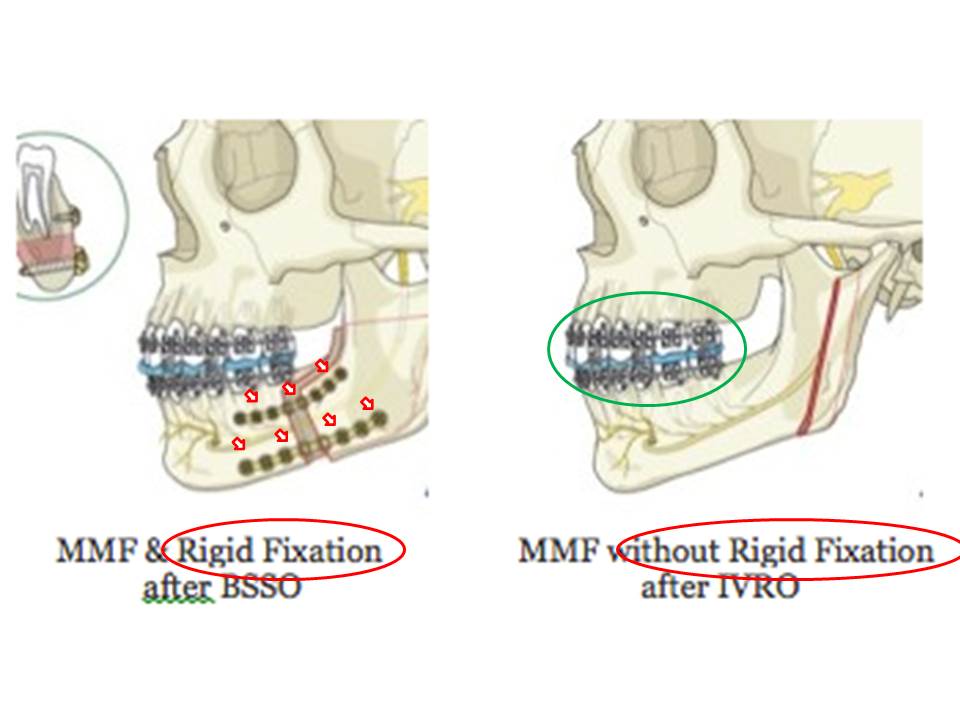 陳怡傑醫師的整形天地 （整形、正顎、削骨）: 正顎手術後神經受損的機率