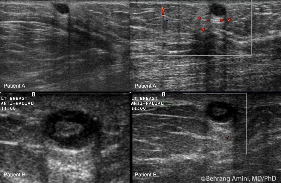 Roentgen Ray Reader: Epidermal Inclusion Cyst