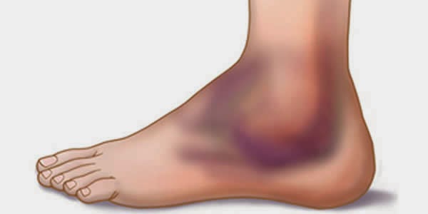 Conoce las lesiones deportivas: Esguince