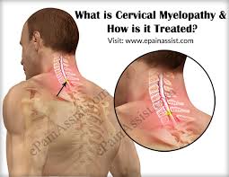Everything to Know About Myelopathy