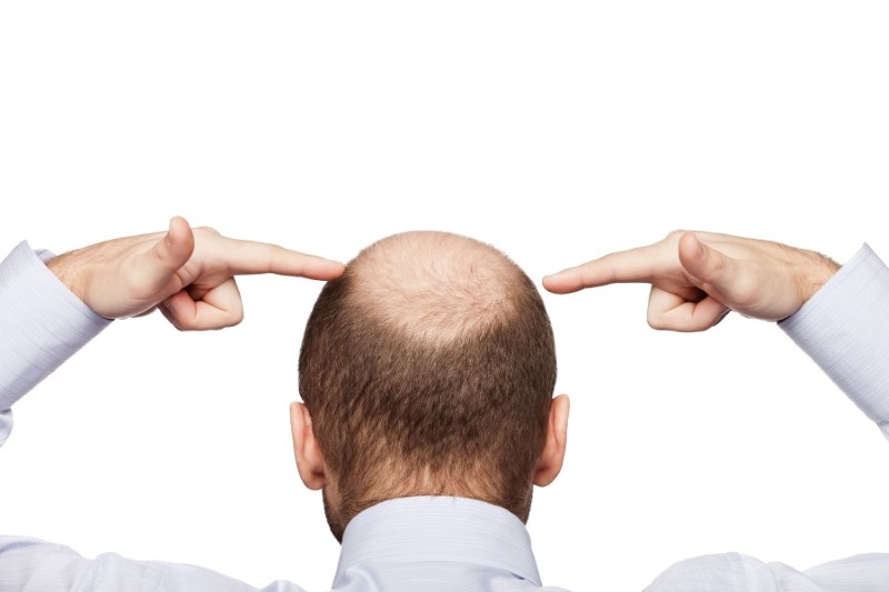 Why do some people become bald? - travel world
