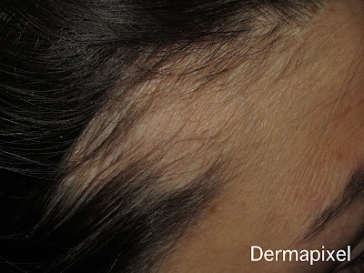 Dermapixel: Pelo que se cae de repente