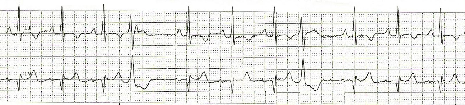 EKG Rhythm Strip Quiz 62