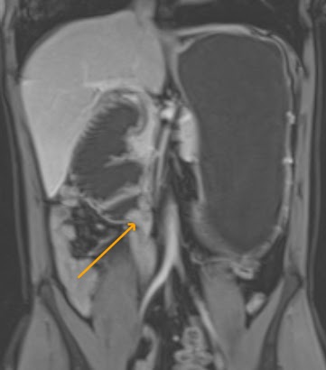 mricases: Intestinal malrotation with duodenal obstruction secondary to ...
