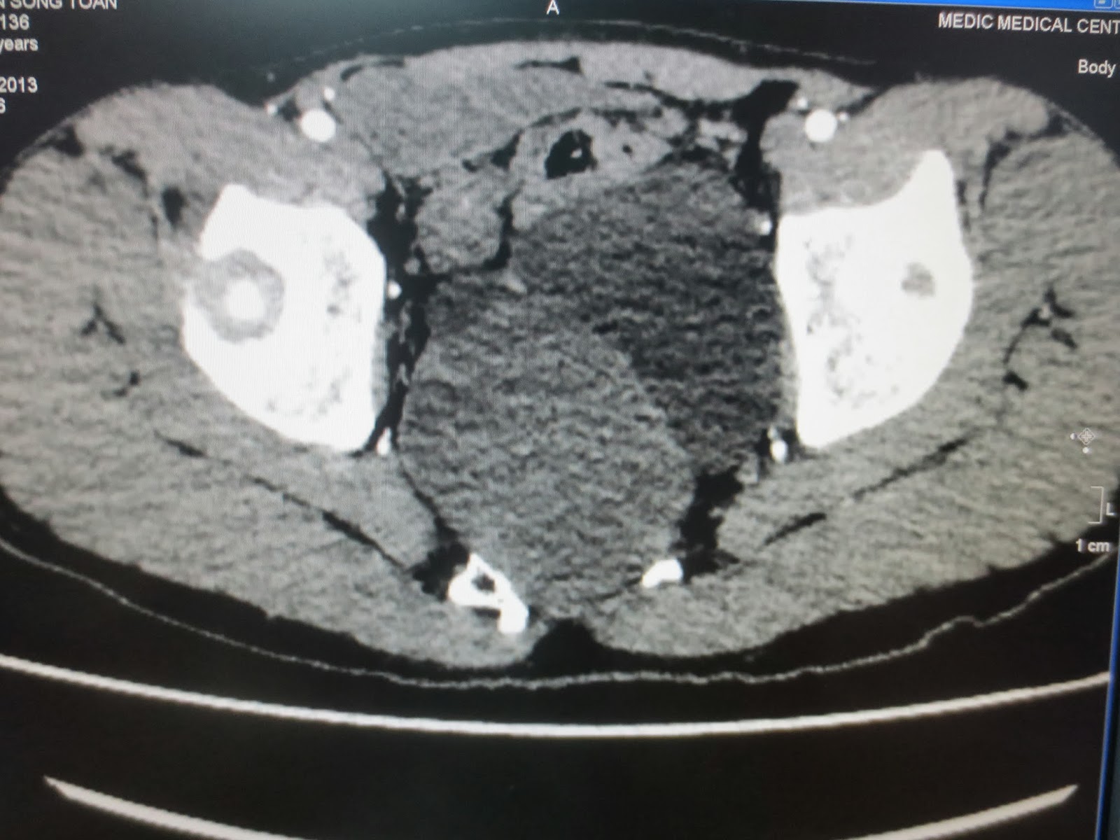 VIETNAMESE MEDIC ULTRASOUND: CASE 211: PRESACRAL EPIDERMOID CYST, Dr ...