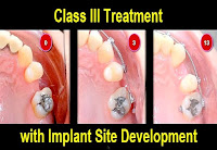 PDF: Roth versus MBT: Does bracket prescription have an effect on the ...