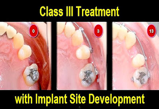 ORTHODONTICS: Rebonding Tips for the Custom Bracket System-Insignia ...