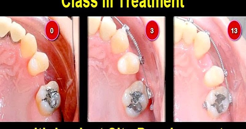 ORTHODONTICS: Class III Treatment with Implant Site Development - Odonto-Tv