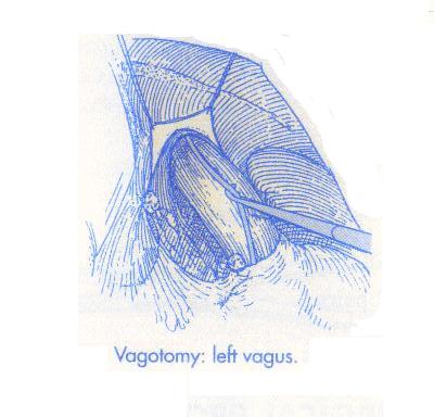 OTMANAGE: VAGOTOMY PROCEDURES 1