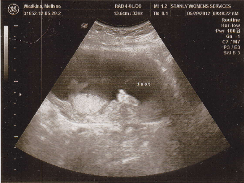 Missy's Journal: 16 Week Ultrasound Pictures