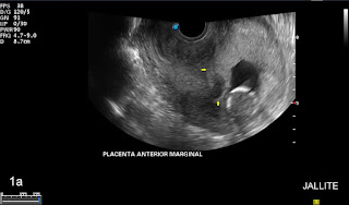 Hematoma Retrocorionico & Placenta Marginal