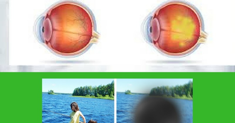 Degeneración macular senil (DMAE)