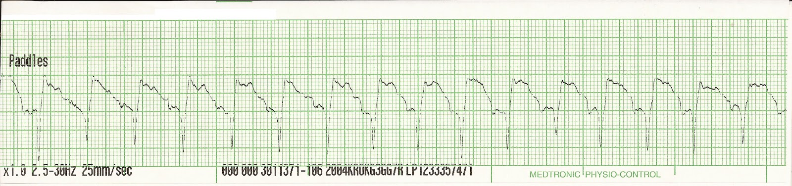 Float Nurse: Pulseless VF/VT