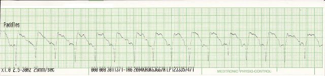 Float Nurse: Pulseless VF/VT