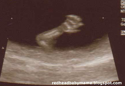 Flashback Friday: Ultrasound Red - Redhead Baby Mama | Atlanta Blogger
