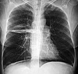 MEDICINA: NEUMOPERITONEO