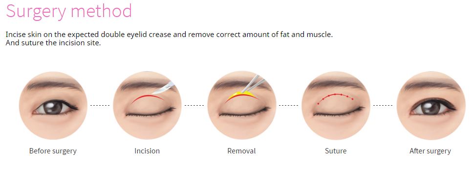 TL Eyeplasty, Rhinioplasty, and Facial Contouring: Incision method ...