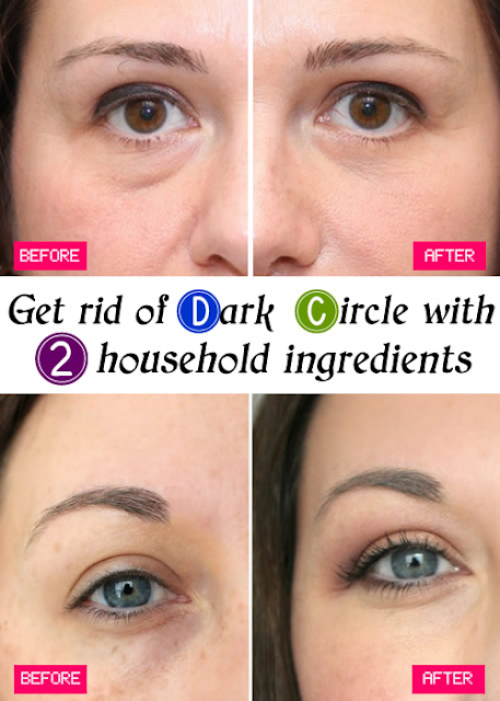 Get rid of Dark Circle with 2 household ingredients - Health Craze