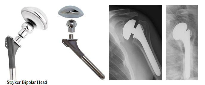 Shoulder and Elbow Surgery: Identifying the implanted shoulder ...