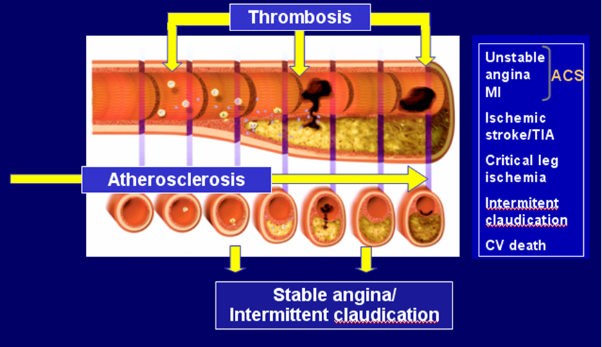 Medical Cardiology Heart Treatment: Pathogenesis of Acute Coronary ...
