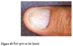 Nail Diseases: Red Nails