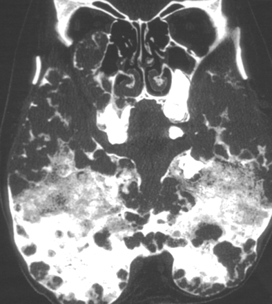 CT/MRI procedures: Cherubism