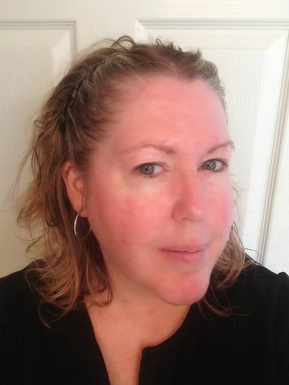 My Journey Through Topical Chemotherapy - Fluorouracil 5% Cream and ...