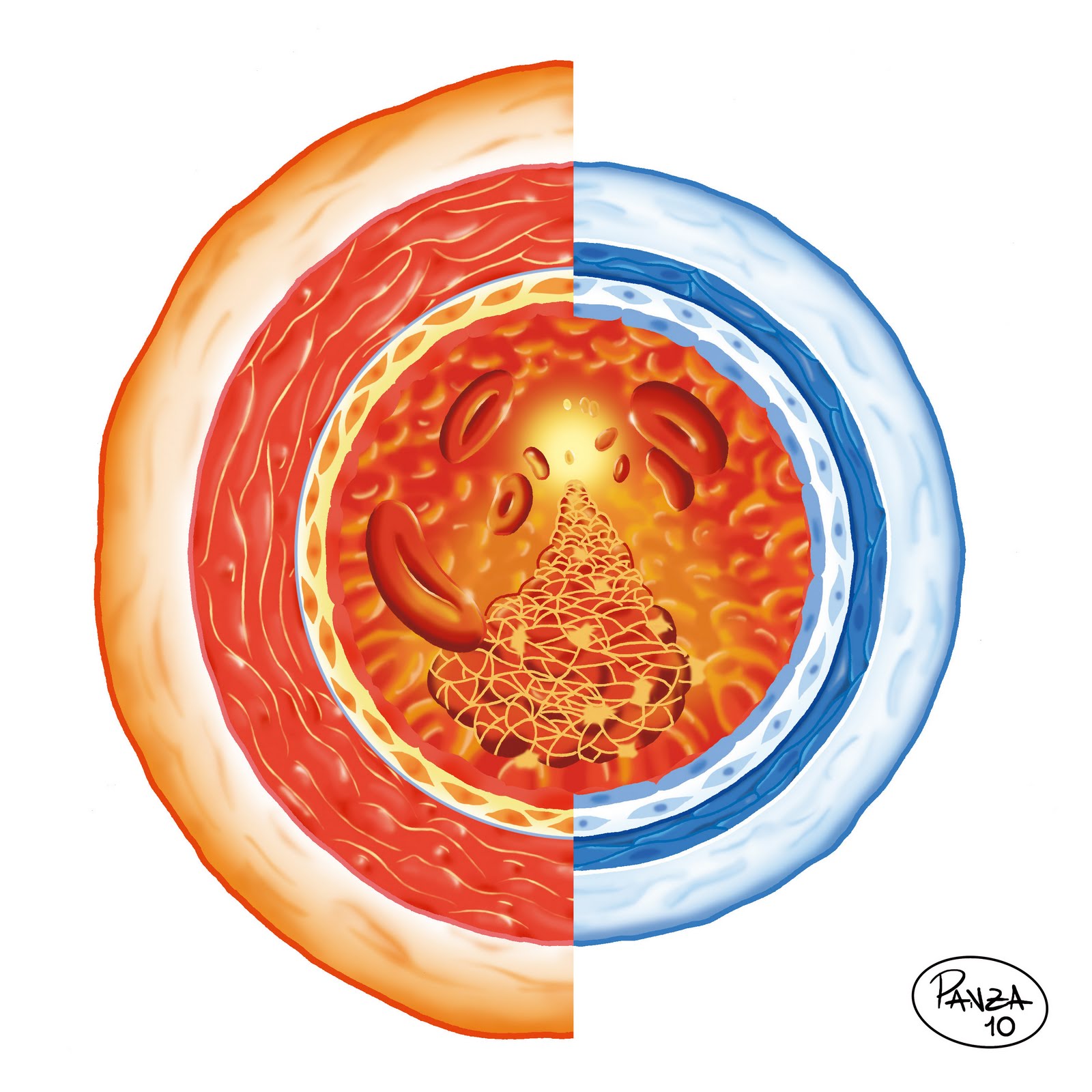 Il Regno del Panza: Calciparina