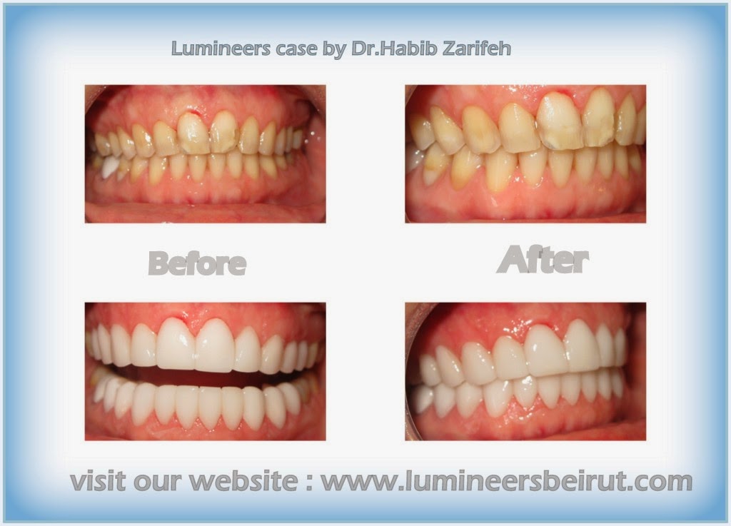 Hollywood smile techniques or options that can give patients optimum ...