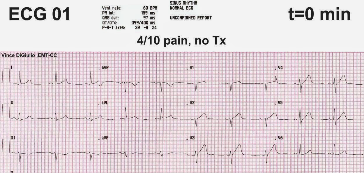 Dr. Smith's ECG Blog: 12 Example Cases of Use of 3- and 4-variable ...