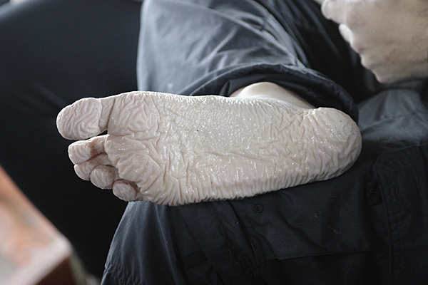 Deformutilation: Trench Foot