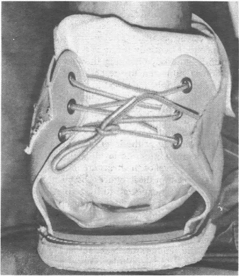 傷口大師: Off-loading 減壓-Scotchcast boot樹脂石膏鞋