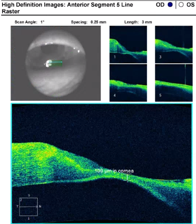 Cornea and Anterior Segment Imaging: Peripheral Ulcerative Keratitis