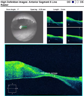 Cornea and Anterior Segment Imaging: Peripheral Ulcerative Keratitis