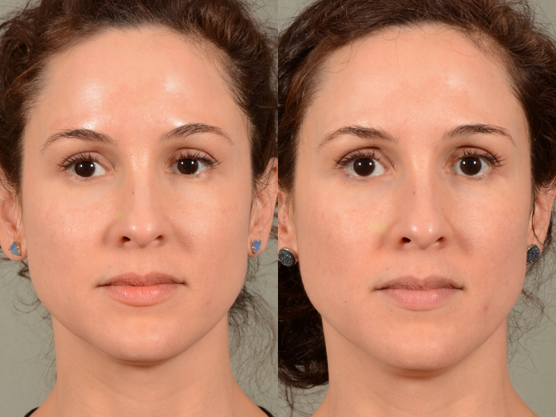 Complection Perfection