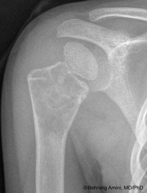 Simple Bone Cyst Fallen Fragment Sign