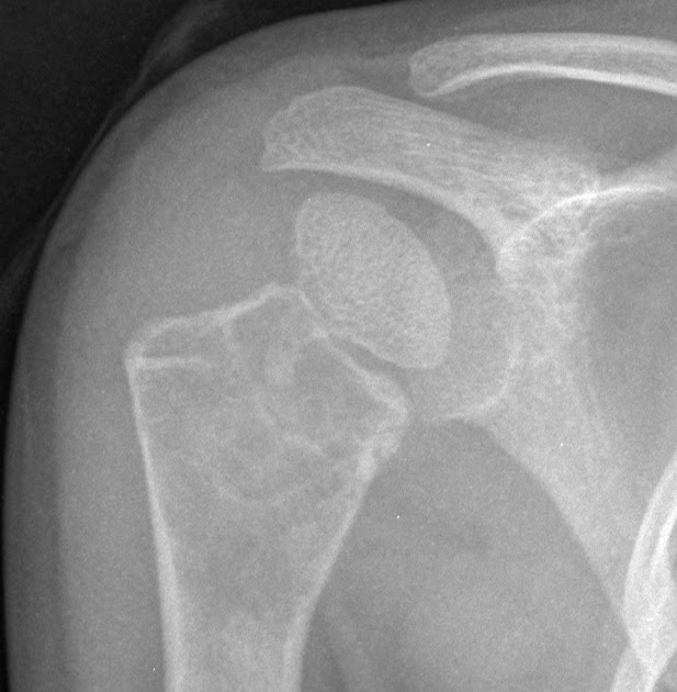 Simple Bone Cyst Fallen Fragment Sign