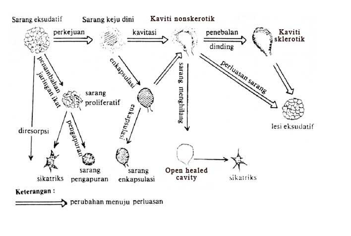 PROMOSI KESEHATAN "TUBERKULOSIS PARU": Definisi dan Faktor Penyebab ...