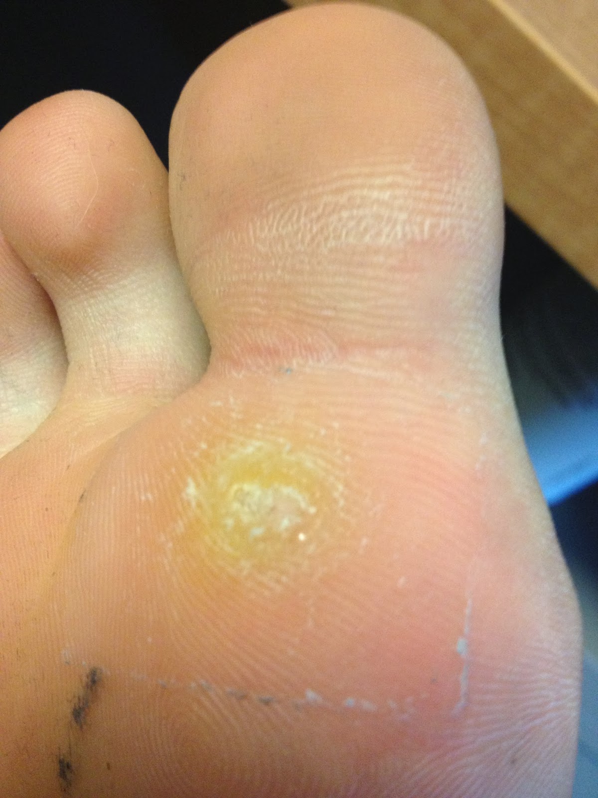 How To Get Rid Of Plantar Warts