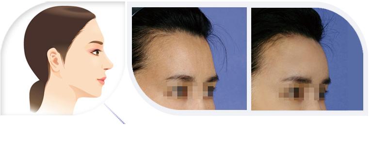Eyelid Surgery Legend Dr. Kim Byung Gun: [Recommended Place for ...