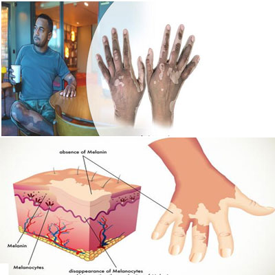 What is Leucoderma and vitligo, homeopathic treatment and home ...