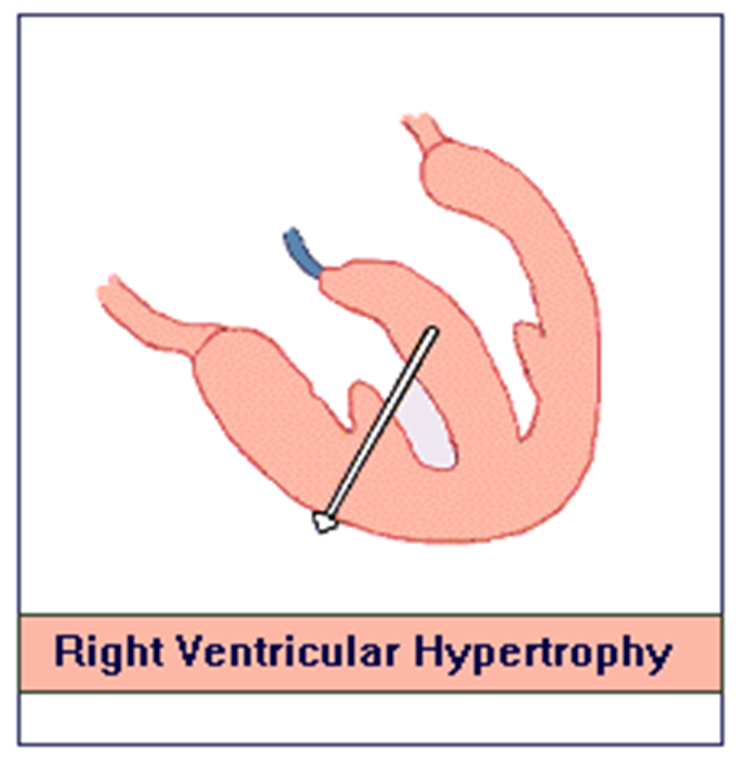 Right Ventricular Hypertrophy (RVH) pada EKG? | SholehShare